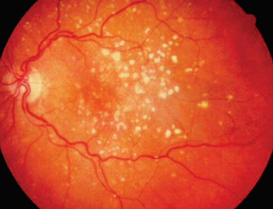 Age Related Macular Degeneration OPTIMAX Eye Specialist Malaysia